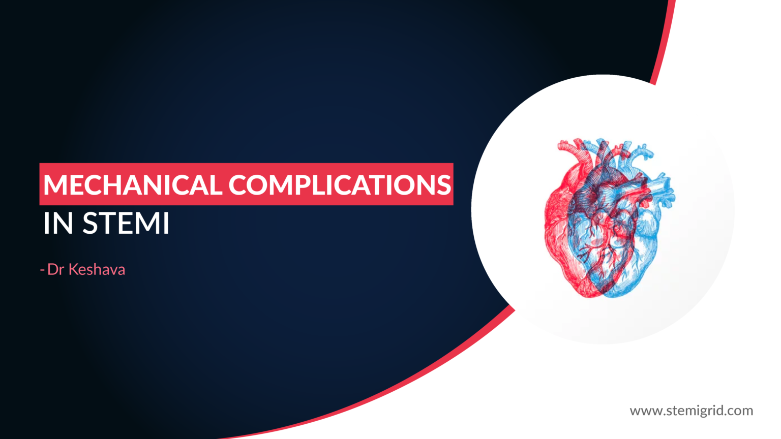 Module 16 – Mechanical Complications – StemiGrid